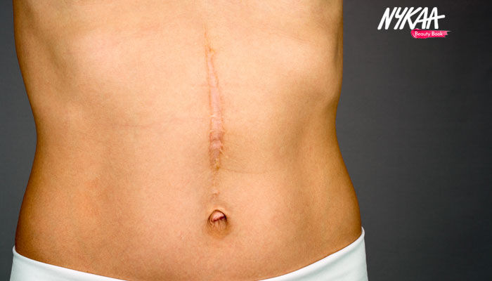 Stubborn scar treatments that work! By Dhimant Goleria